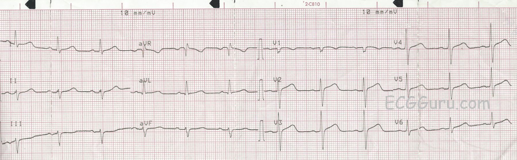 Subtle ST Elevation And Left Anterior Hemiblock | ECG Guru - Instructor Resources